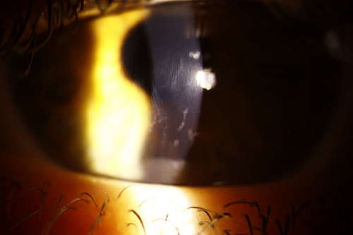 Ocular manifestations in Down Syndrome - nzoptics