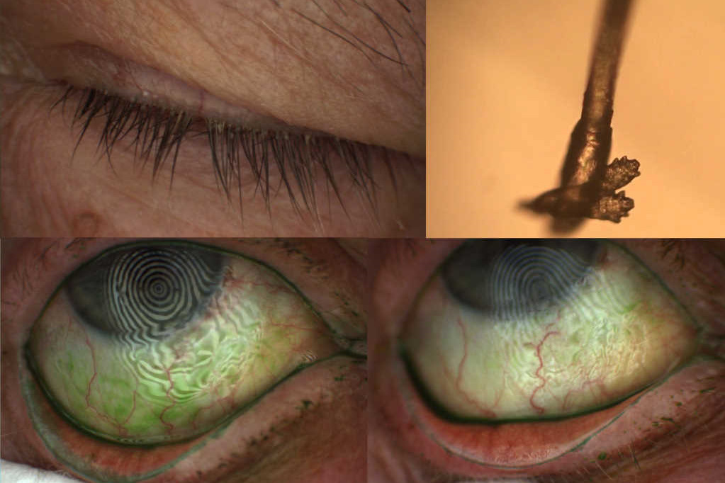 Manuka honey cream for blepharitis