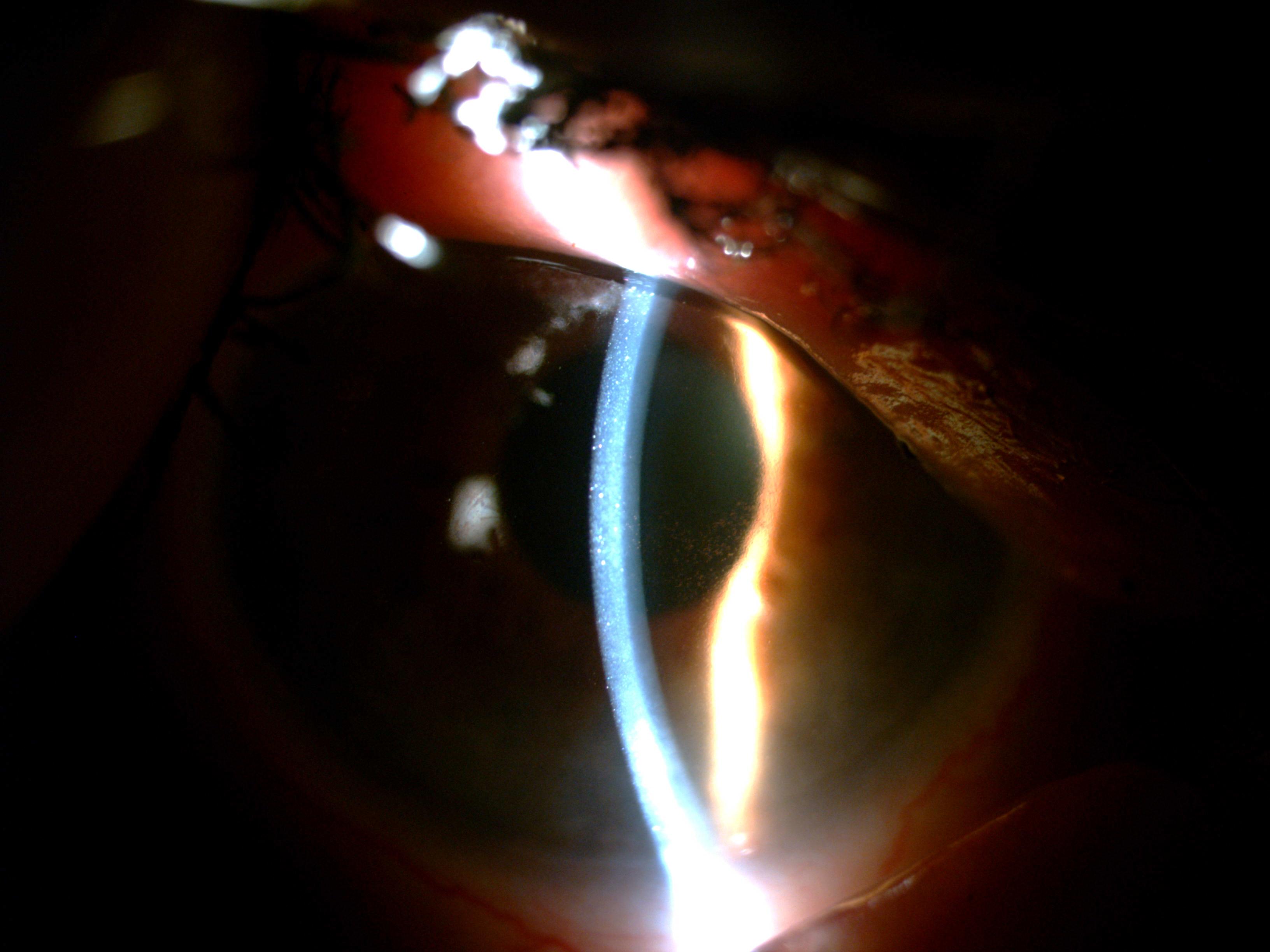 Case study: There was an old lady who fly sprayed her eye…