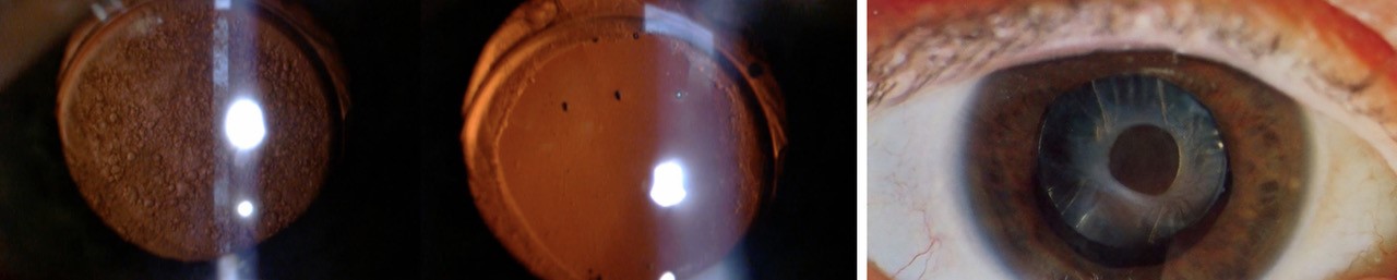 Residual refractive error after cataract surgery